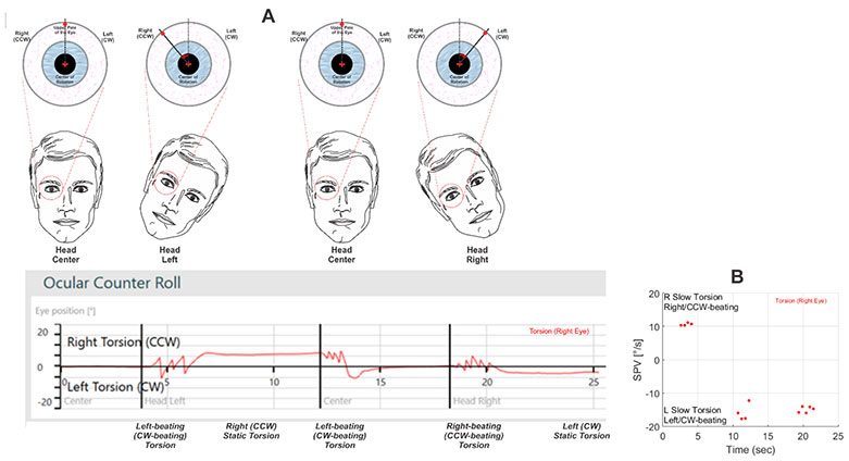 Understanding torsional eye movements | Interacoustics