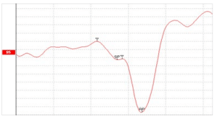 Eclipse | Basic Electrocochleography (ECochG) | Interacoustics