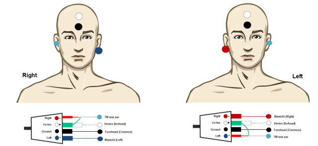 Eclipse | Cochlear Microphonics | Interacoustics