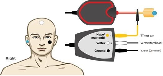 Eclipse | Basic Electrocochleography (ECochG) | Interacoustics