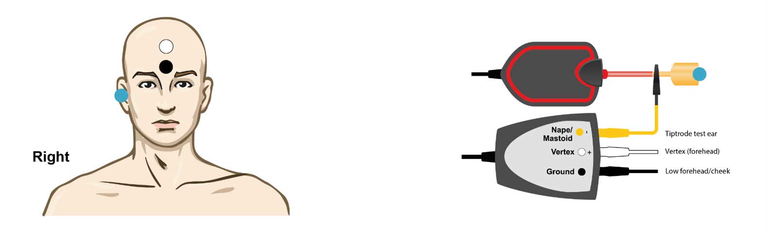 Eclipse | Basic Electrocochleography (ECochG) | Interacoustics