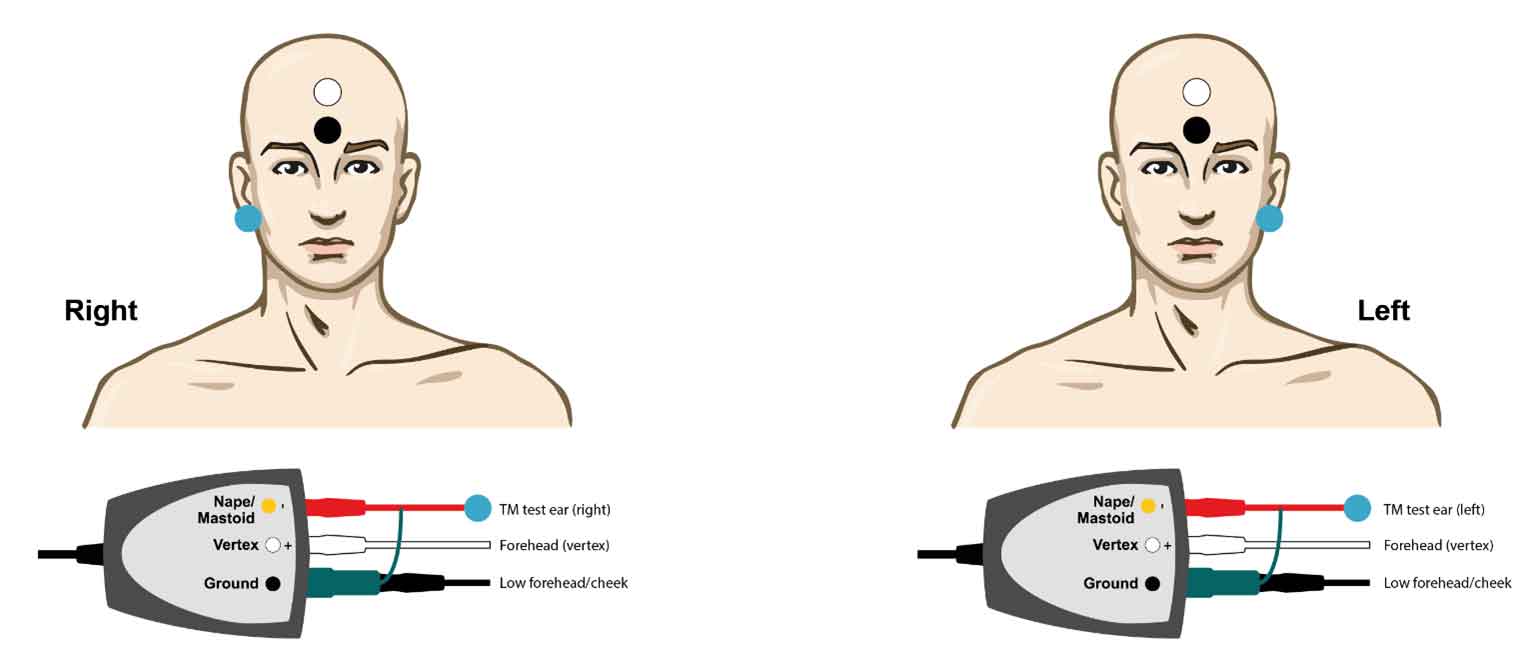 Eclipse | Basic Electrocochleography (ECochG) | Interacoustics