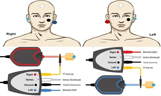 Eclipse | Basic Electrocochleography (ECochG) | Interacoustics