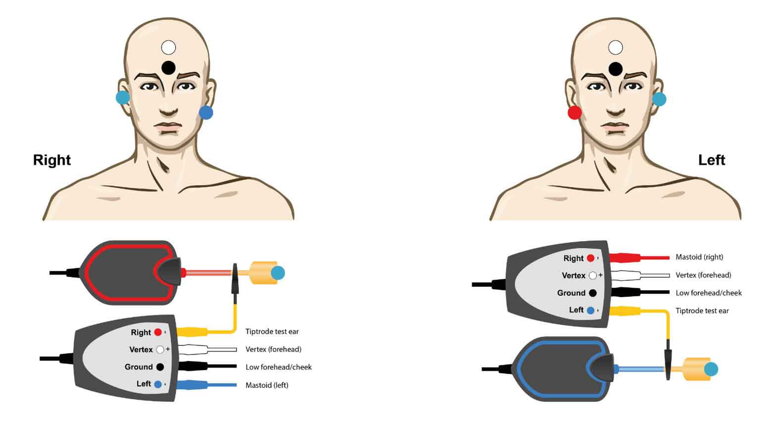 Eclipse | Basic Electrocochleography (ECochG) | Interacoustics