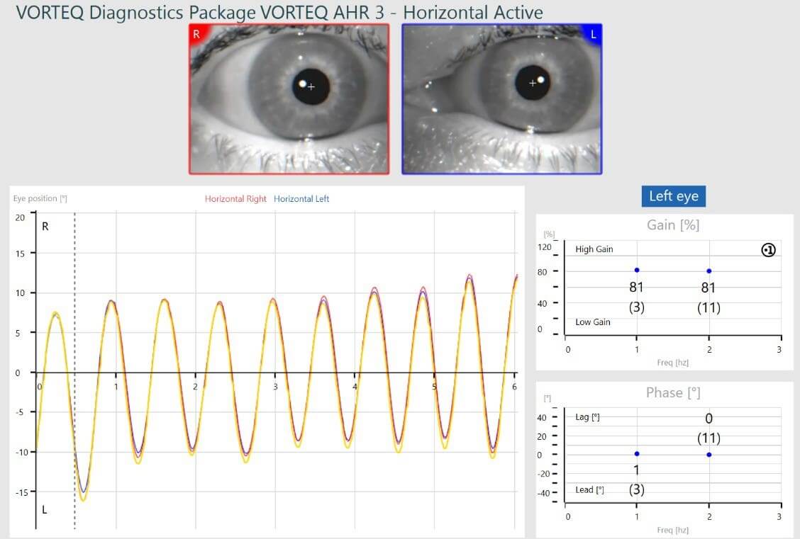 VisualEyes™ | Active Head Rotation | Interacoustics