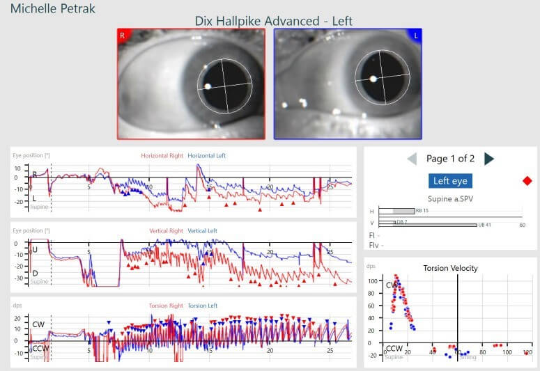 VisualEyes™ | Advanced Dix-Hallpike | Interacoustics