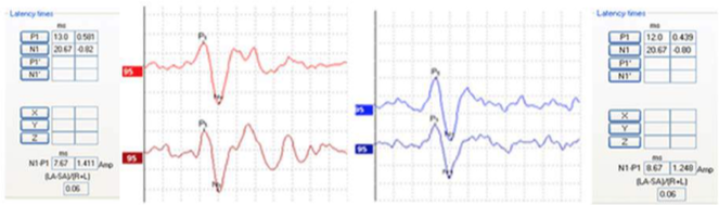 cVEMP testing with Eclipse