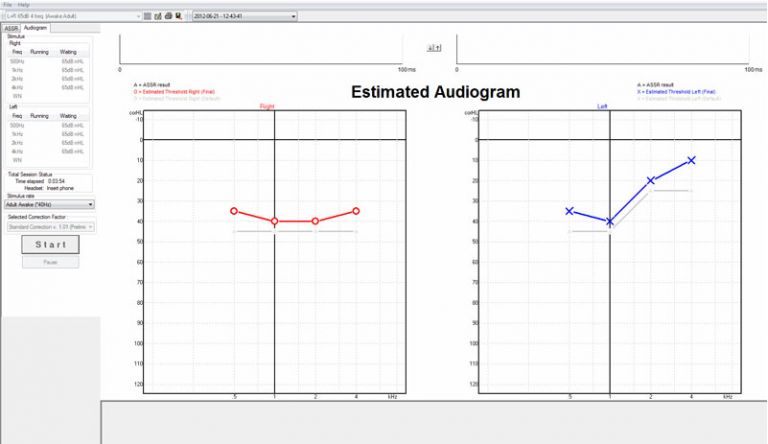 Eclipse | Evoked potentials device | Interacoustics