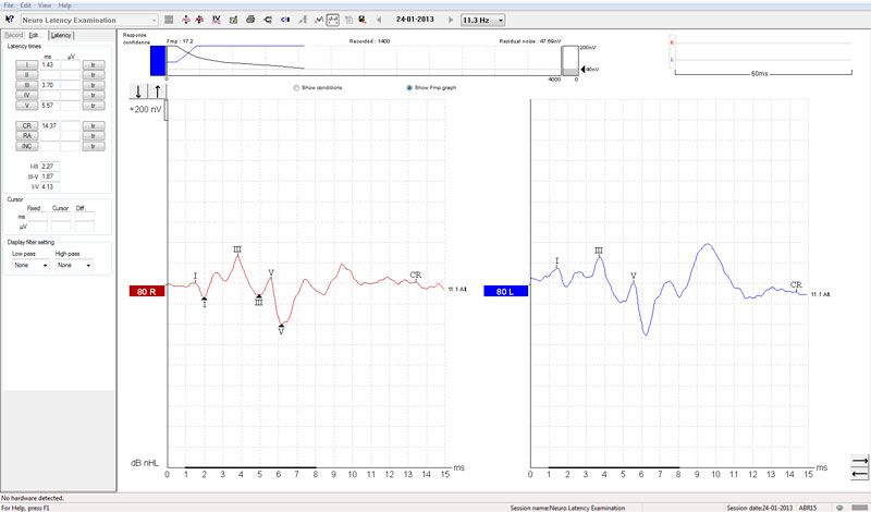 Eclipse | Evoked potentials device | Interacoustics